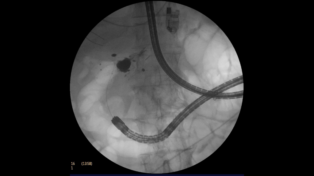 Total gastrectomy (choledocholithiasis) double balloon ERCP (F.J ...