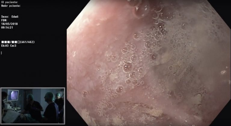 Septostomia Divertículo de Zenker con SB-Junior (Dr Martín/Dr Alcaín ...