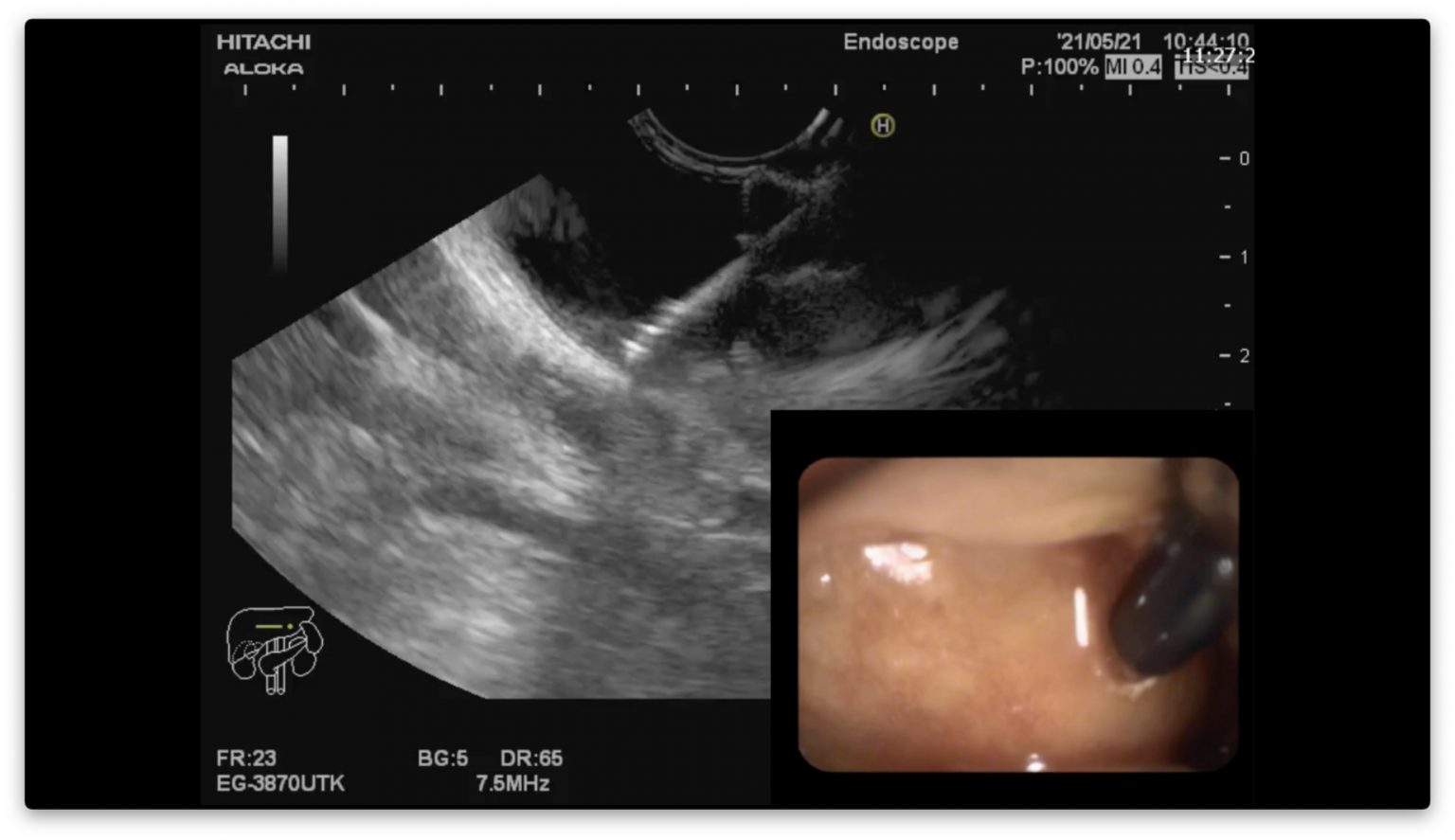 EUS choledochoduodenostomy (pancreatic IMPN) (F.J. Gallego/L. Miras ...